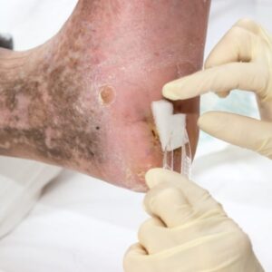 Buffalo Wound Care & Hyperbaric Medicine